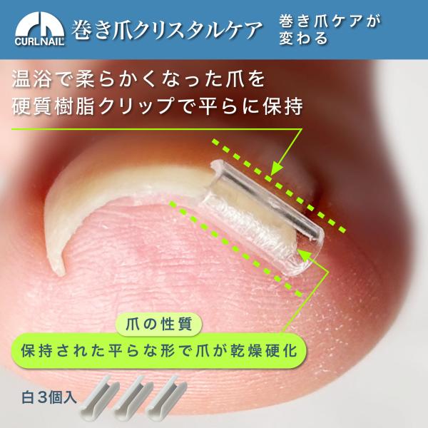 【巻き爪を真っ直ぐ「固める」次世代ケア】 温浴後の柔らかい爪が乾く時に形が決まる。この爪の性質を活かし、平らな状態で固定する理にかなったケアです。バネやゴムの反発力ではなく、爪に優しい全く新しいケアです。■バネじゃないからスライドするだけで...