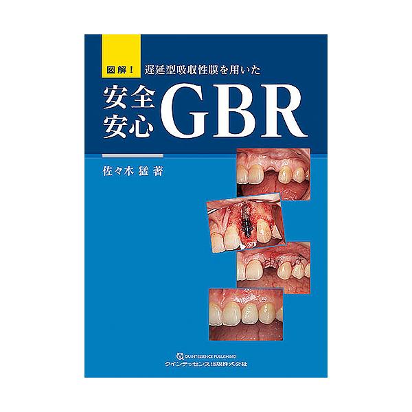 ※商品画像はイメージや仮デザインが含まれている場合があります。帯の有無など実際と異なる場合があります。著:佐々木猛出版社:クインテッセンス出版発売日:2018年11月キーワード:図解！遅延型吸収性膜を用いた安全安心GBR佐々木猛 ずかいちえ...