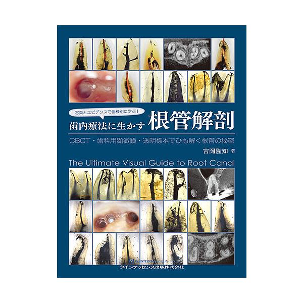 ※商品画像はイメージや仮デザインが含まれている場合があります。帯の有無など実際と異なる場合があります。著:吉岡隆知出版社:クインテッセンス出版発売日:2019年06月キーワード:写真とエビデンスで歯種別に学ぶ！歯内療法に生かす根管解剖CBC...