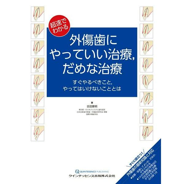 クインテッセンス出版 【1237】 突然来院する、歯の破折、露髄、脱臼、埋入、脱離などの外傷歯の患者の治療では、「そのまま保存してOK？」「抜髄・抜歯してOK？」「予後は？？」と多くの疑問と不安が・・・・・・。14の外傷歯の治療で「すぐやる...