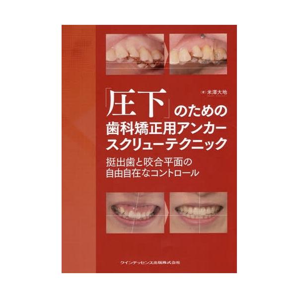 【発売日：2015年05月28日】米澤大地/著/「圧下」のための歯科矯正用アンカースクリューテクニック 挺出歯と咬合平面の自由自在なコントロール、メディア：BOOK、発売日：2015/05、重量：568g、商品コード：NEOBK-18093...