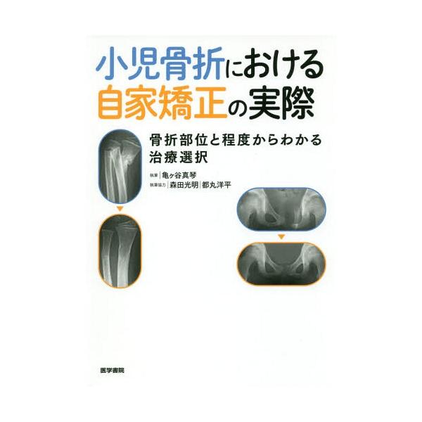 【発売日：2017年05月22日】亀ケ谷真琴/執筆/小児骨折における自家矯正の実際 骨折部位と程度からわかる治療選択、メディア：BOOK、発売日：2017/05、重量：611g、商品コード：NEOBK-2097761、JANコード/ISBN...