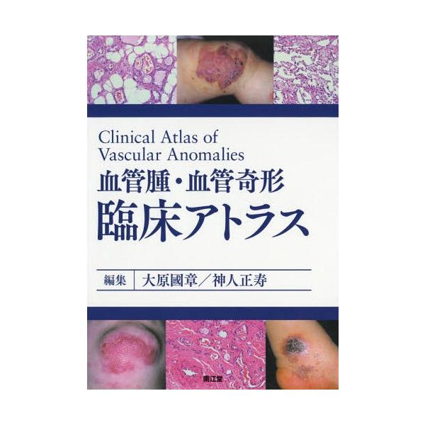 【発売日：2018年05月28日】大原國章/編集 神人正寿/編集/血管腫・血管奇形臨床アトラス、メディア：BOOK、発売日：2018/05、重量：340g、商品コード：NEOBK-2235041、JANコード/ISBNコード：9784524...