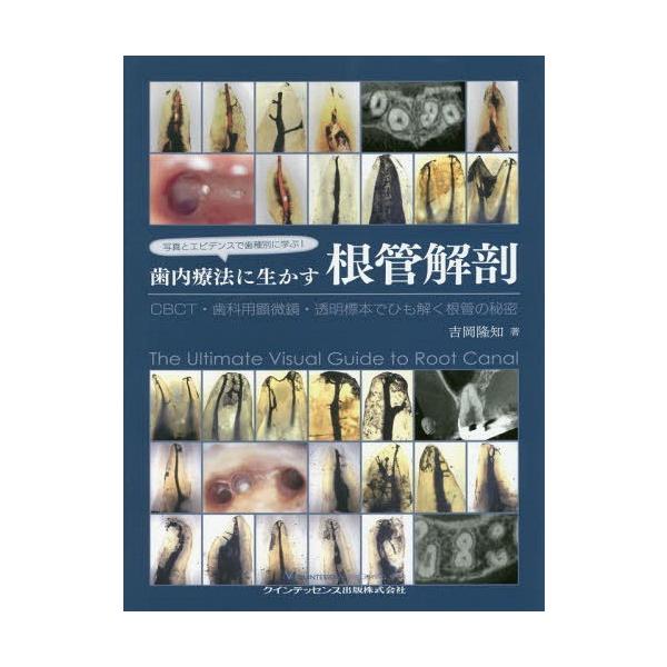 【発売日：2019年06月28日】吉岡隆知/著/写真とエビデンスで歯種別に学ぶ!歯内療法に生かす根管解剖 CBCT・歯科用顕微鏡・透明標本でひも解く根管の秘密、メディア：BOOK、発売日：2019/06、重量：340g、商品コード：NEOB...