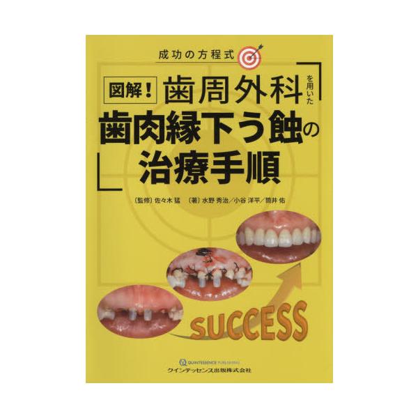 【発売日：2019年12月28日】佐々木猛/監修 水野秀治/著 小谷洋平/著 筒井佑/著/図解!歯周外科を用いた歯肉縁下う蝕の治療手順 成功の方程式、メディア：BOOK、発売日：2019/12、重量：565g、商品コード：NEOBK-244...