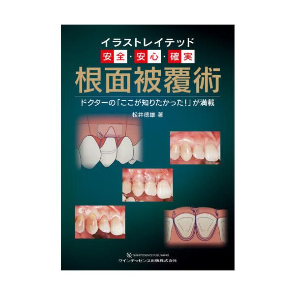 【発売日：2021年06月28日】松井徳雄/著/イラストレイテッド安全・安心・確実 根面被覆術 ドクターの「ここが知りたかった!」が満載、メディア：BOOK、発売日：2021/06、重量：500g、商品コード：NEOBK-2623651、J...