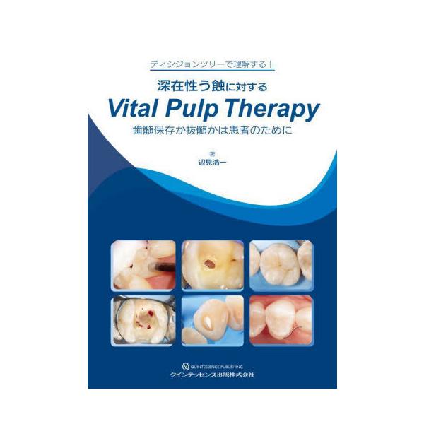 【発売日：2025年08月08日】辺見浩一/著/深在性う蝕に対するVital Pulp Therapy 歯髄保存か抜髄かは患者のために ディシジョンツリーで理解する!、メディア：BOOK、発売日：2025/08、重量：500g、商品コード：...