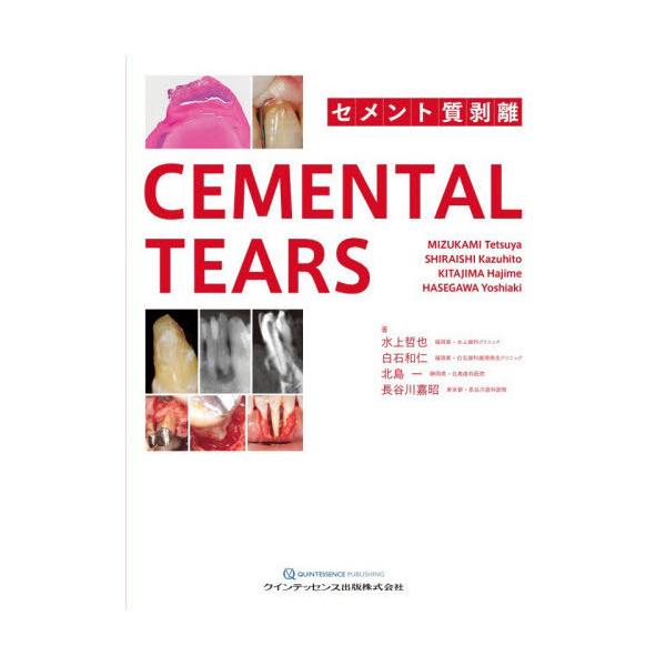 【発売日：2026年10月09日】水上哲也/〔ほか〕著/セメント質剥離、メディア：BOOK、発売日：2026/10、重量：500g、商品コード：NEOBK-3254605、JANコード/ISBNコード：9784781213194