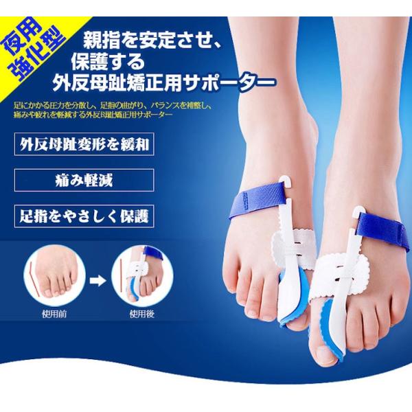 外反母趾矯正ベルトです。主にご就寝前など、靴を脱いでいる状態でご使用ください。当店販売の日中用、外反母趾矯正サポーターと併せてご利用いただきますと、効果的です。外反母趾悪化を防ぎ、歩行時の痛みを和らげます。足の指をやさしく保護いたします。強...