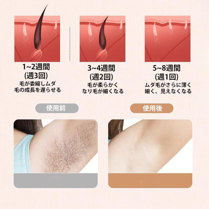 脱毛器メンズ 髭 vio IPL光脱毛器 無痛脱毛 99万発照射 脱毛機 5段階調節 全身用 氷感 女性 全身脱毛 LED液晶 家庭用 脱毛 除毛 レーザー脱毛器 プレゼント ...