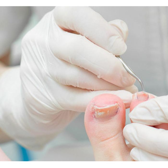 ニッパー爪切り (br65) 4点セット 日本国内当日発送 ネイルニッパー 巻き爪 グルーミング 硬い爪 厚い爪 ネイルケア ゾンデ 介護 高齢 つめきり 足の爪 陥入爪 : hanae19 ...