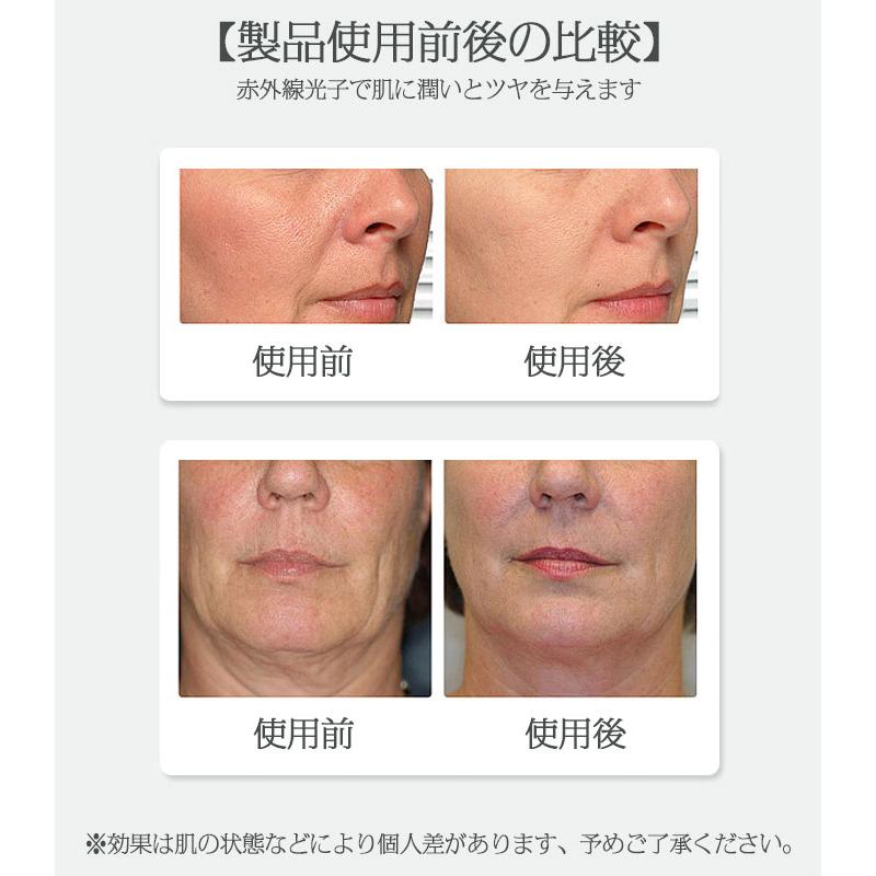 フェイスリフティング 美顔器 赤外線 光子 超音波 LED L&L SKIN フェイスリフティング 美顔器 赤外線 光子 超音波 LED L&L SKIN