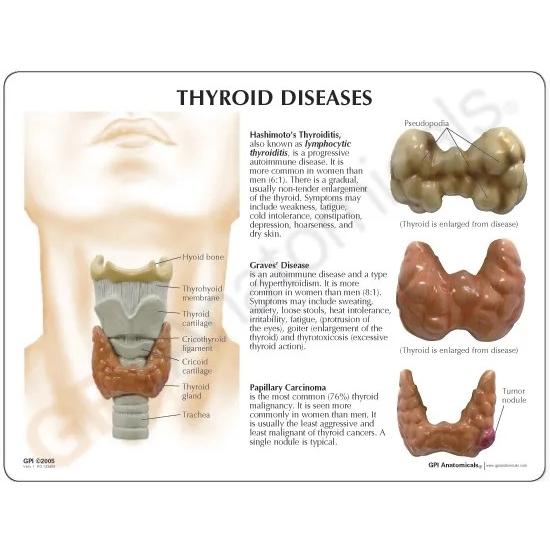 医学模型 甲状腺疾患 日本語訳付き GPI Anatomicals : 人体百科ヤフー店 - 通販 - Yahoo!ショッピング