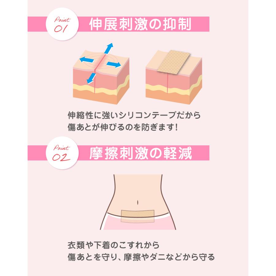 傷あとケアテープ ケロイド テープ 傷あとケア用シリコンジェルシート 手術後 帝王切開 (Lサイズ 5cm×16cm ) : NORAHヤフー店 - 通販 - Yahoo!ショッピング