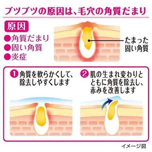 (第3類医薬品)ニノキュア ( 30g )/ ニノキュア 二の腕などの ブツブツ治療薬 クリームタイプ ) : 爽快ドラッグ - 通販 ...