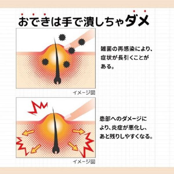 オデキュアEX 12g 池田模範堂 化膿性皮膚疾患 とびひ おでき【第2類医薬品】 :KH21900:LOHACO Yahoo!店 - 通販 - Yahoo!ショッピング